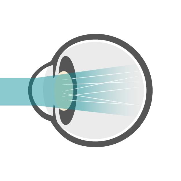 Cataracts | Southern Eye Center